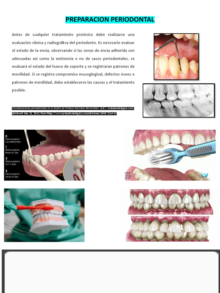 Preparacion Periodontal Fernando PPR | PDF | Ciencia y matemáticas