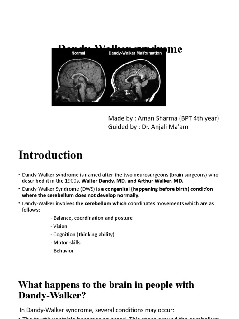 Dandy Walker Syndrome Pdf Brain Neuroscience