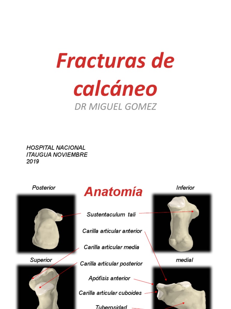 Fractura de Calcaneo | PDF | Tobillo | Anatomía humana
