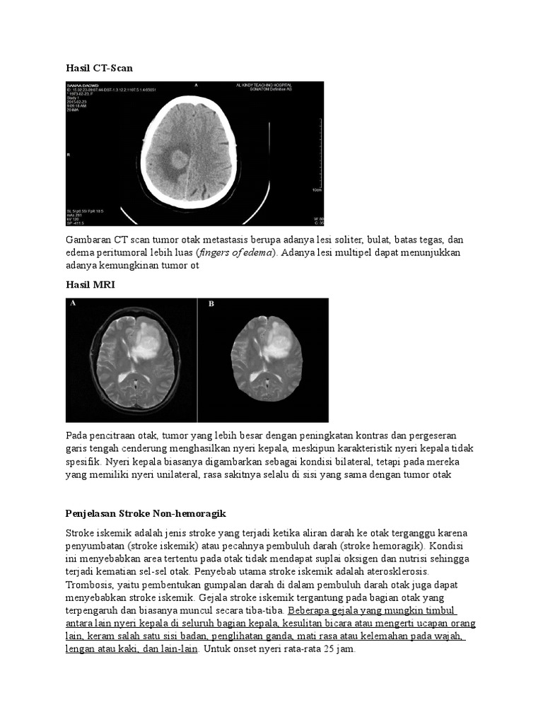 Stroke Non-Hemoragik Dan Hasil CT&MRI | PDF