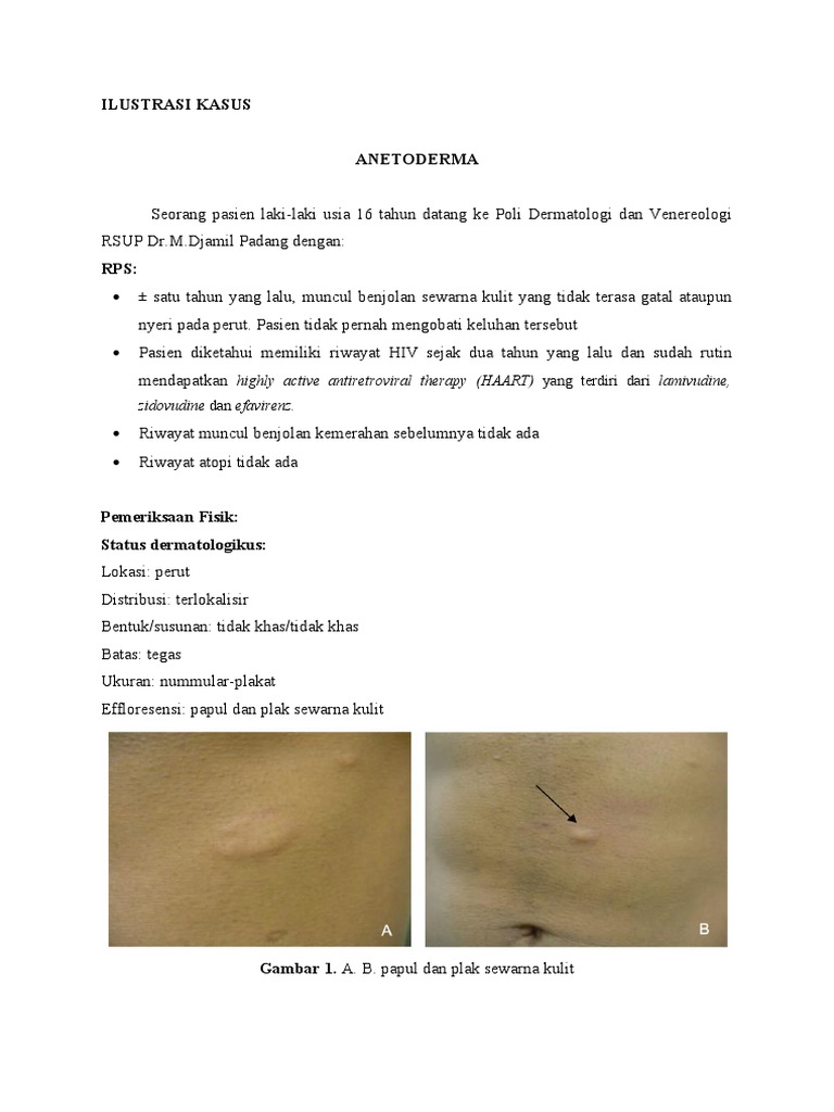 Ilustrasi Kasus Anetoderma | PDF