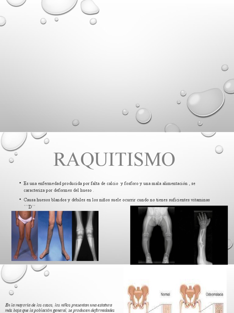 Raquitismo | PDF