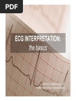 Left Anterior Fascicular Block (LAFB) - LITFL - ECG Library Diagnosis ...