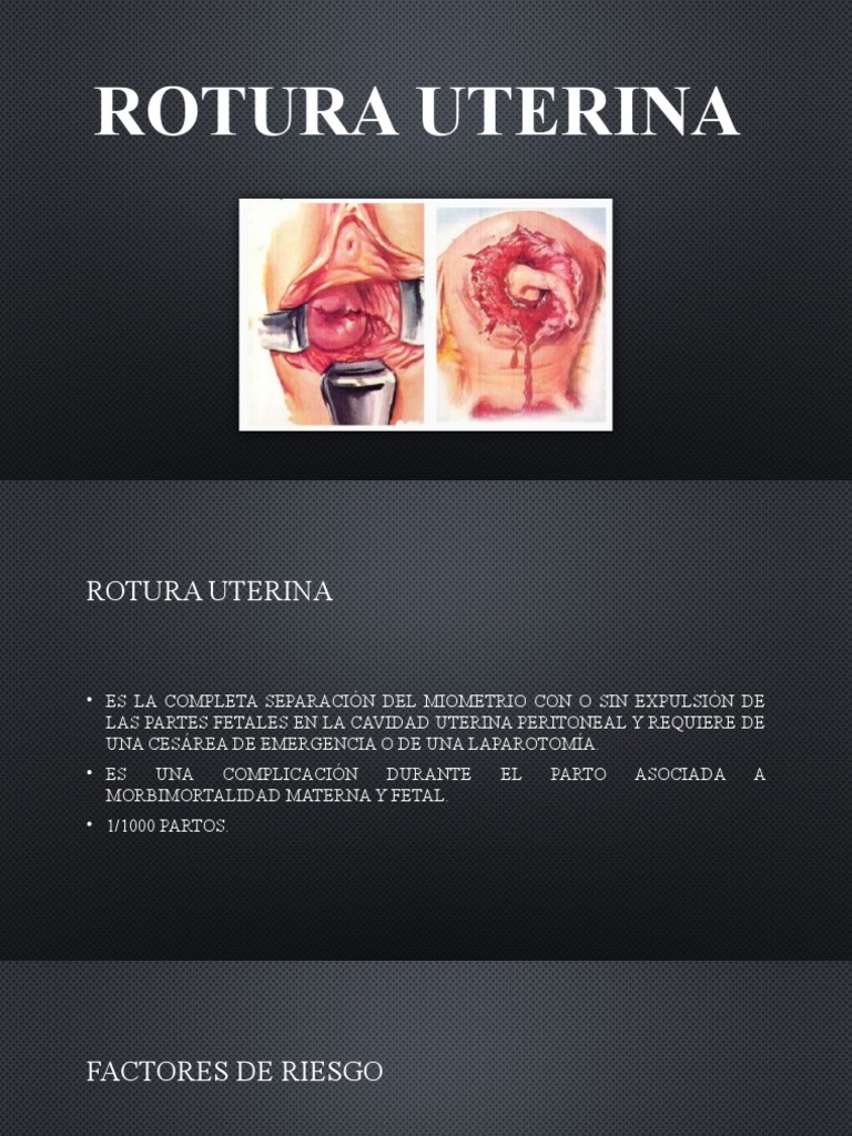 Rotura Uterina | PDF | Parto | Salud maternal