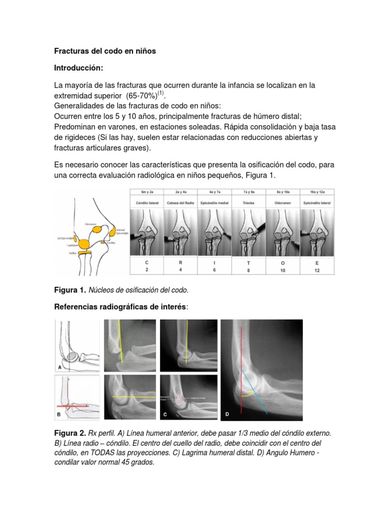 Fracturas Del Codo en Niños | PDF