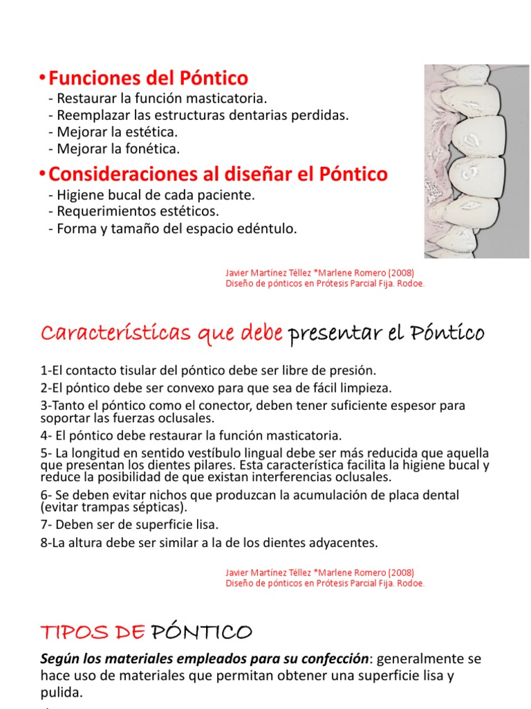 Pontico PPF1 | PDF
