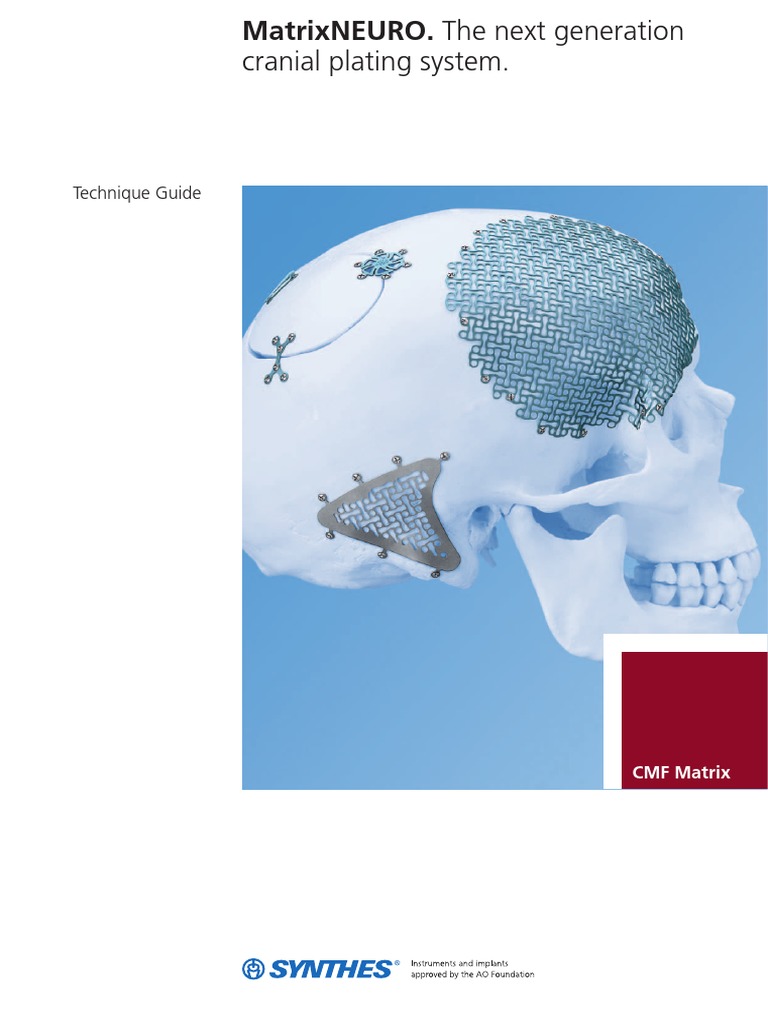 MatrixNEURO Cranial Plating Guide | PDF | Computers