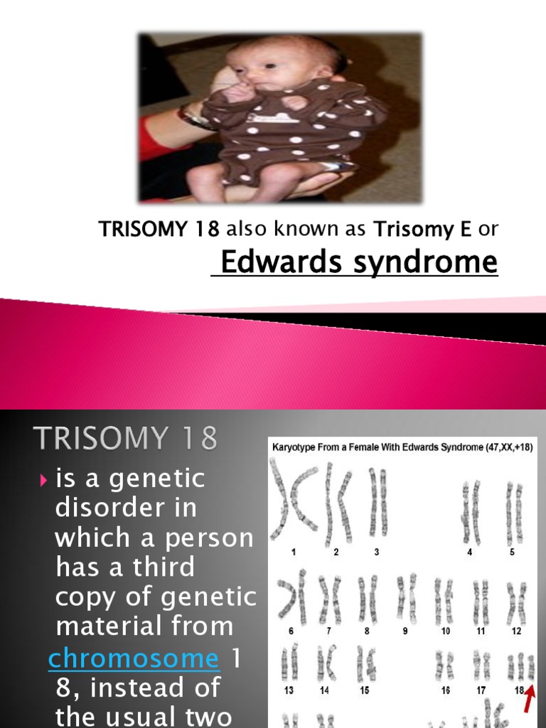 Edwards Syndrome: TRISOMY 18 Also Known As Trisomy E or | Download Free ...