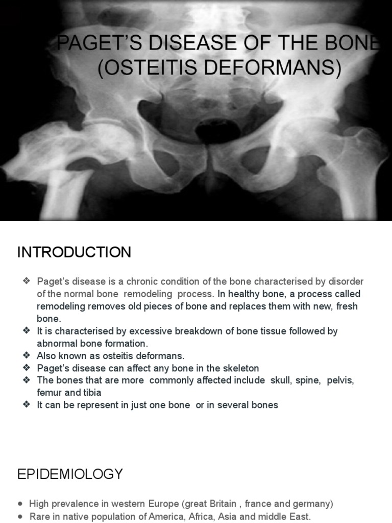 Paget's Disease of The Bone | PDF | Bone | Skeletal System