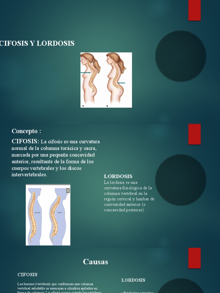 CIFOSIS.pptx25 | PDF | La columna vertebral | Vértebra