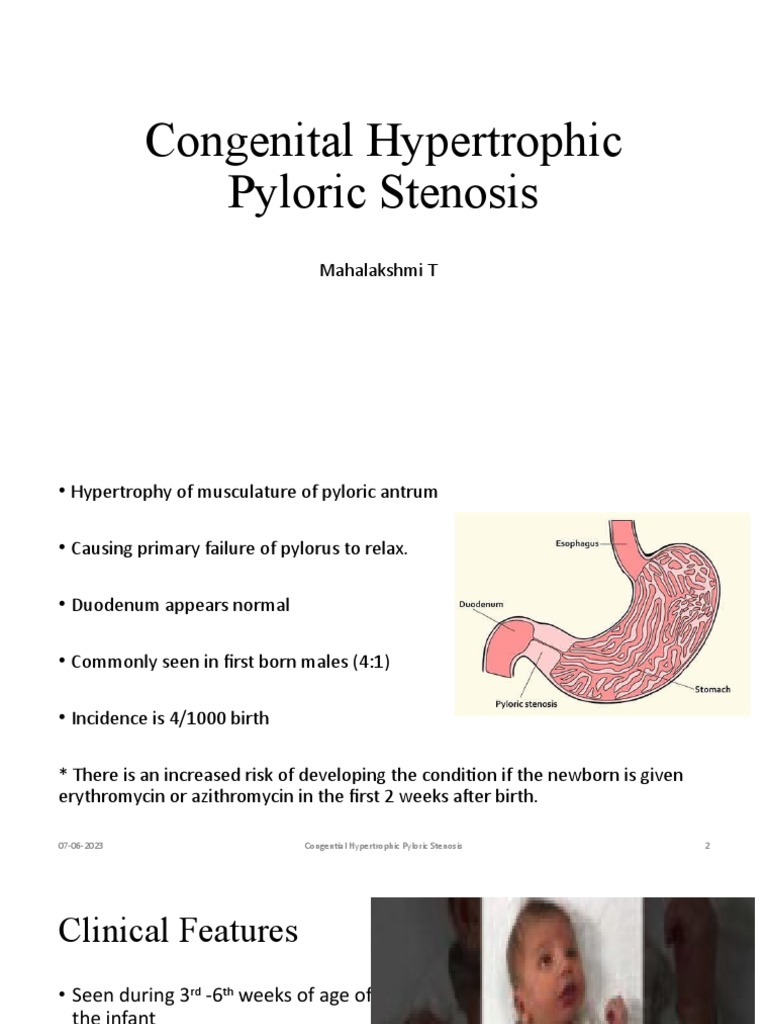 Double Track Sign Pyloric Stenosis