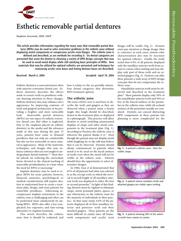 Esthetic RPD | PDF | Dentures | Dental Implant