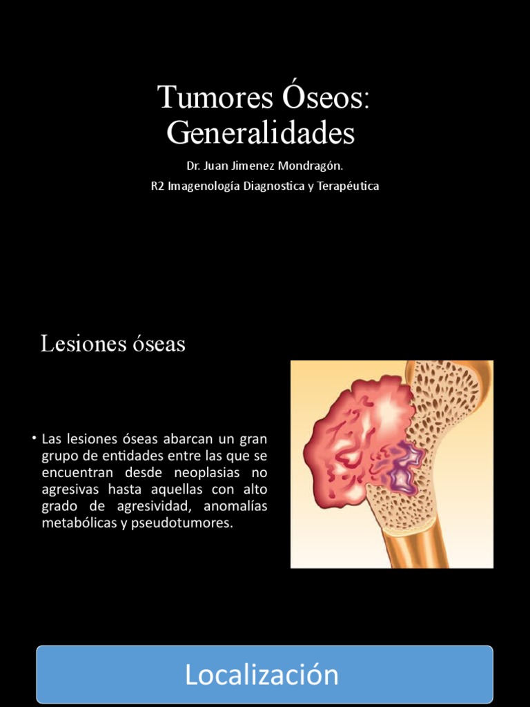 Tumores Óseos | PDF | Hueso | Neoplasias