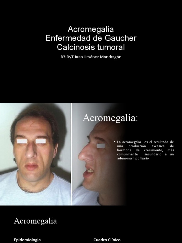 Acromegalia: Epidemiología y Cuadro Clínico | PDF | Hueso | Medicina ...
