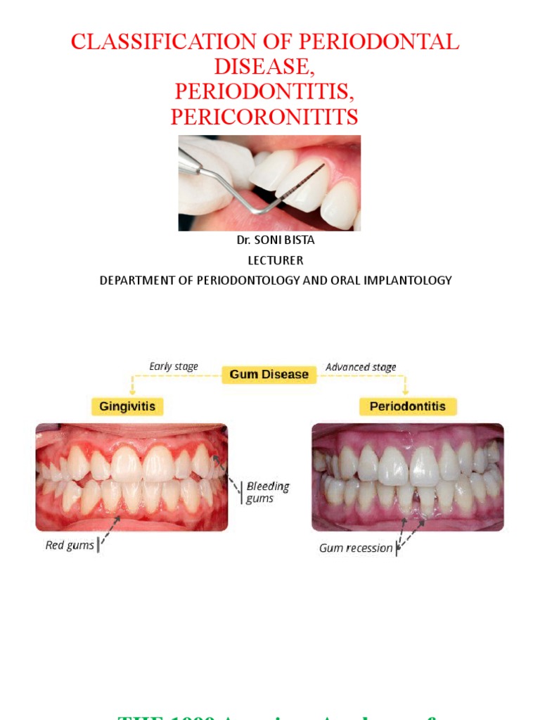Classification of Periodontal Diseases | PDF | Wellness | Science ...