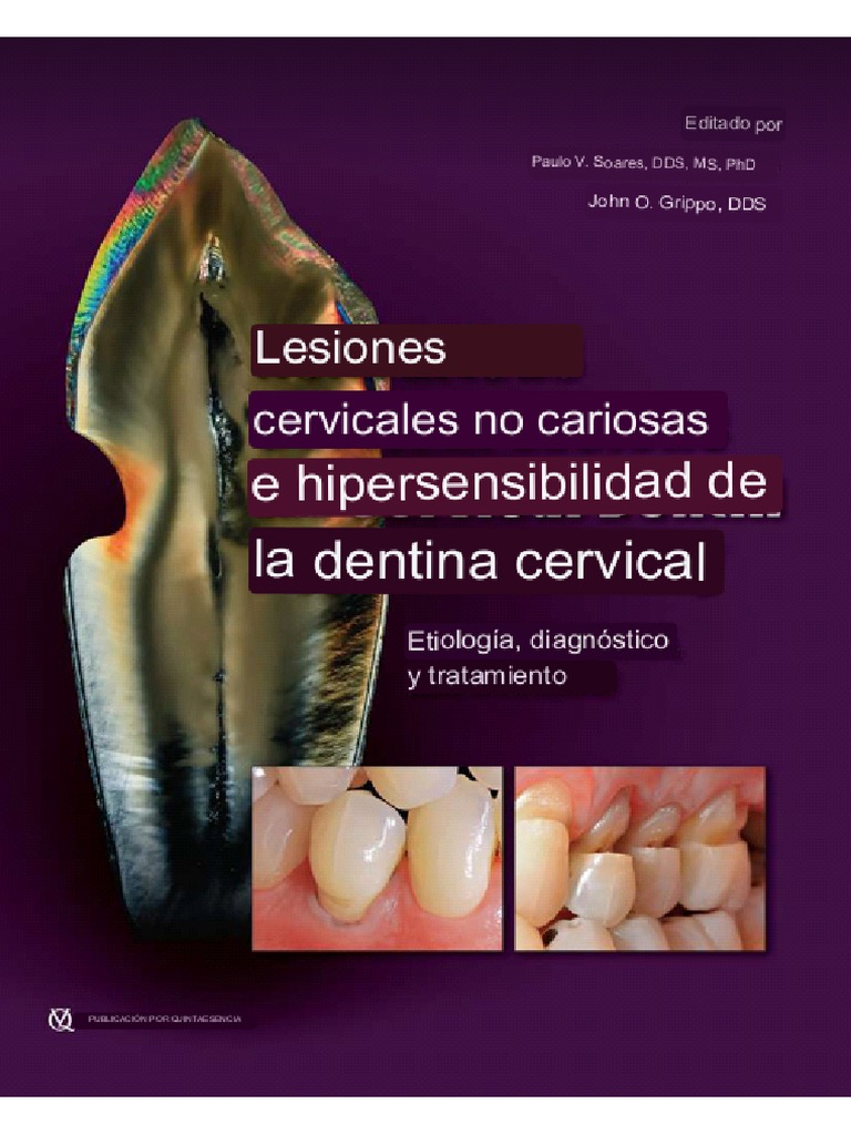 Lesiones Cervicales No Cariosa | PDF | Odontología | Diente