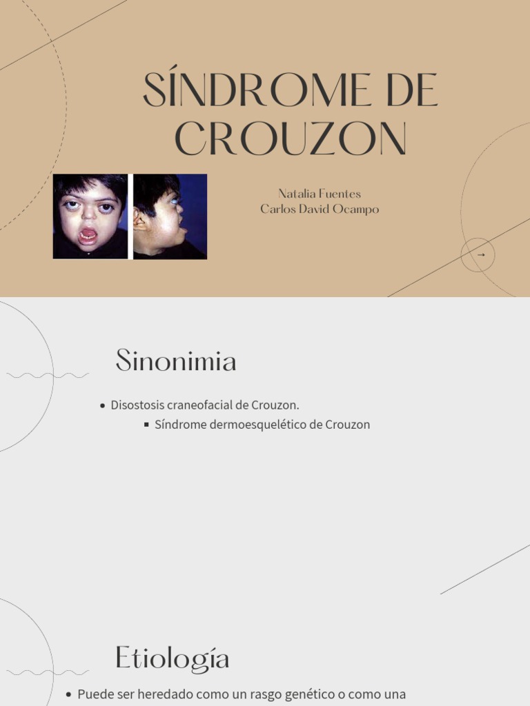 Síndrome de Crouzon: Causas y Tratamiento | PDF | Medicina CLINICA ...