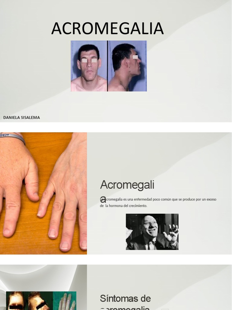 Acromegalia Corregido | PDF | Hormona | Hormona de crecimiento
