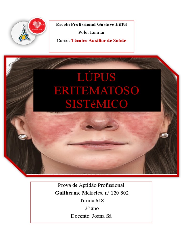 Pap - Lupus Eritematoso Sistémico | PDF | Sistema imunológico | Glóbulo branco