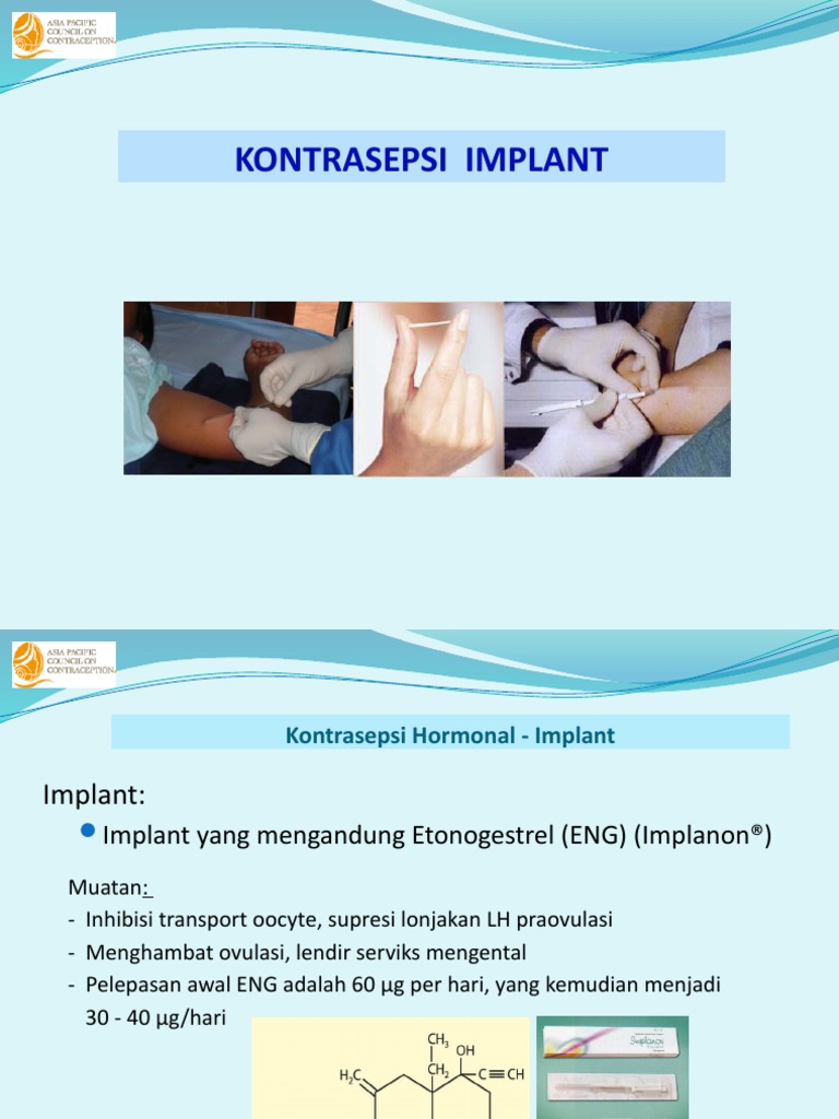 Panduan Pemasangan KB Implan | PDF