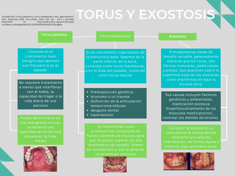 Torus y Exostosis. | PDF | Especialidades Medicas | Medicina CLINICA