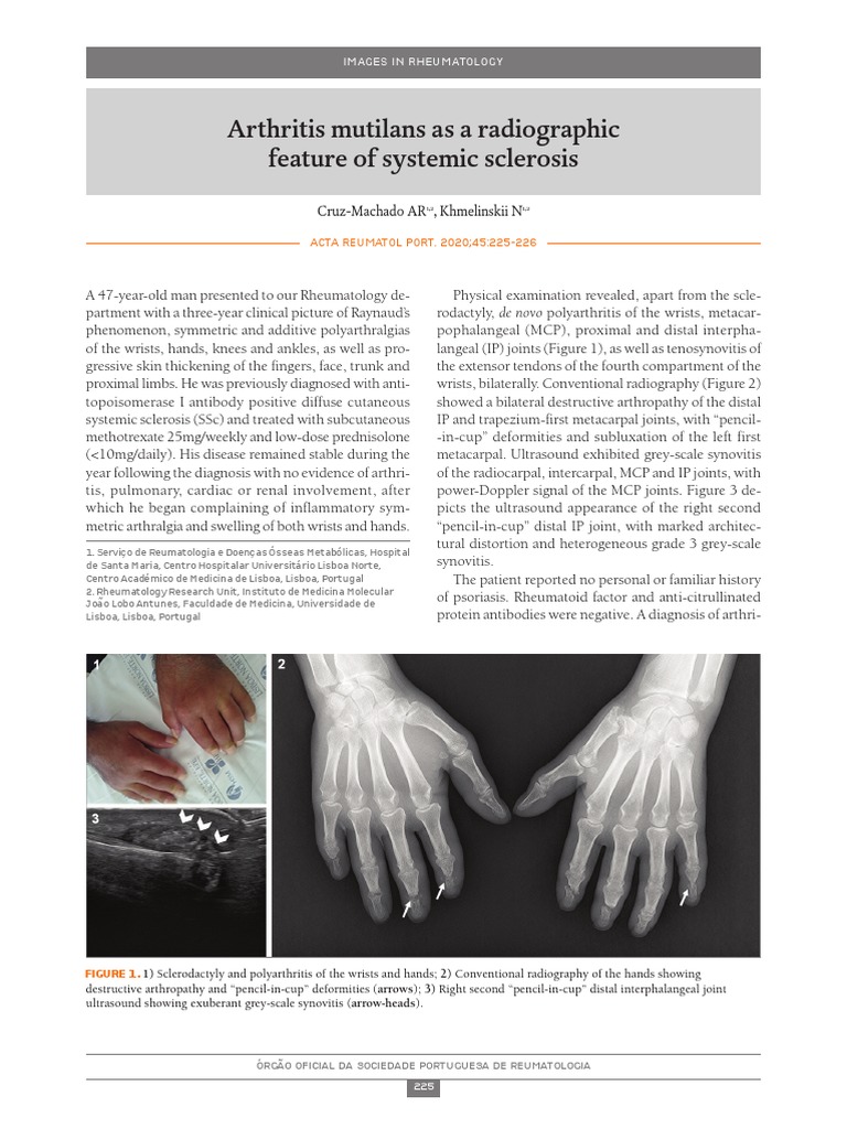 1320 Arthritis Mutilans As A Radiographic Feature of Systemic Sclerosis ...