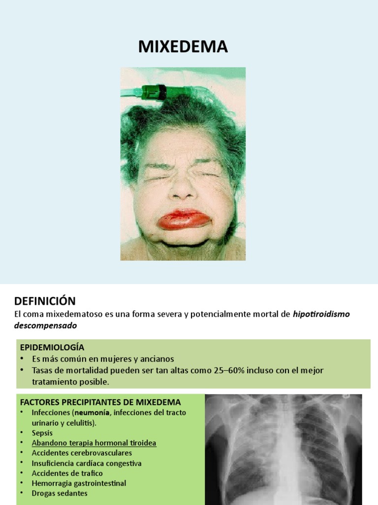 Clase 18 - Mixedema | PDF
