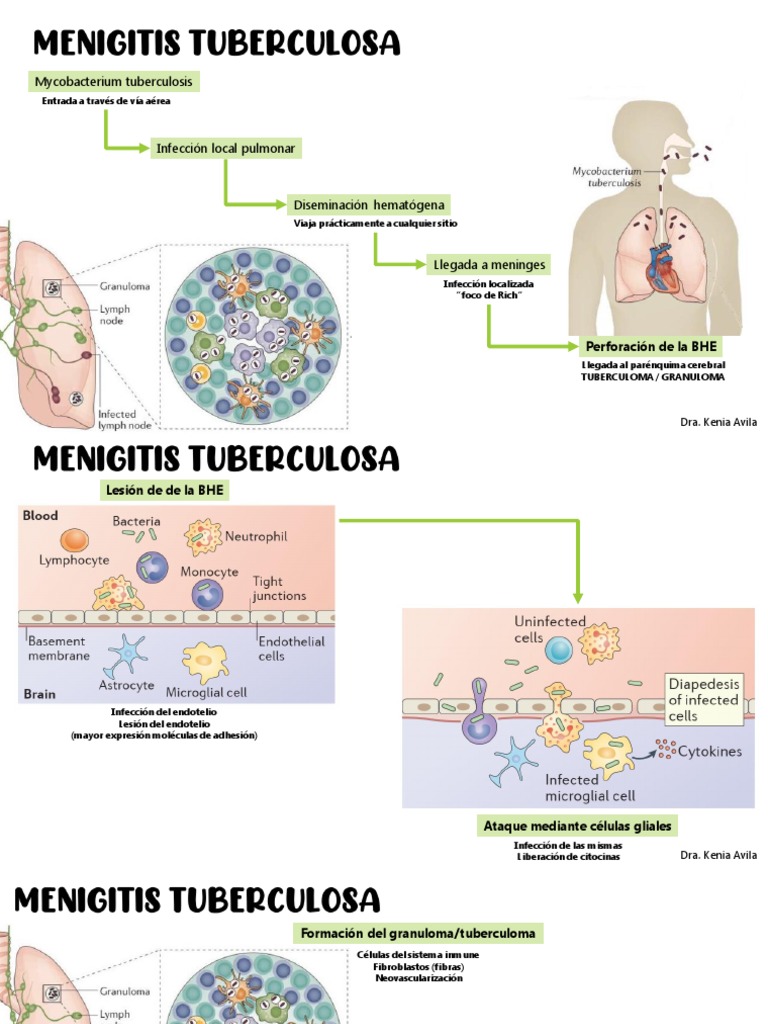 Meningitis Tuberculosa | PDF | Meningitis | Tuberculosis