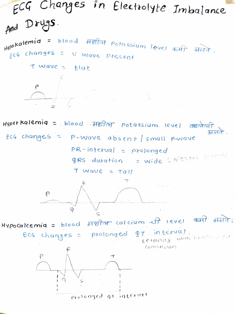 Electrolyte Imbalance | PDF | Electrocardiography | Cardiac ...