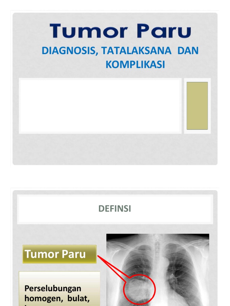 Biko Tumor Paru | PDF