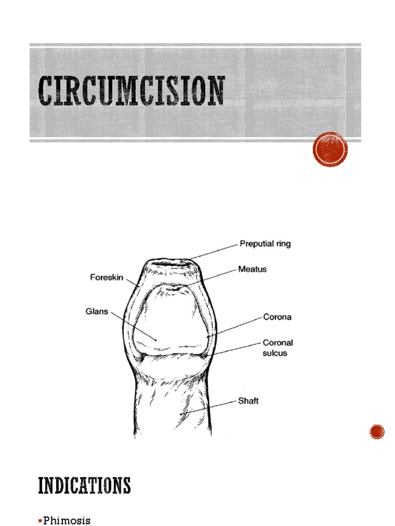 V Cut Circumcision