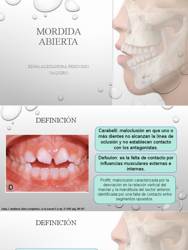 Clasificación y Tratamiento de Mordida Abierta | PDF