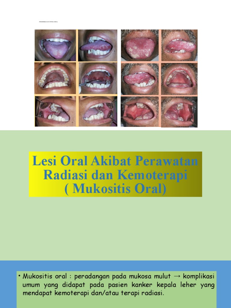 Oral Mukositis | PDF
