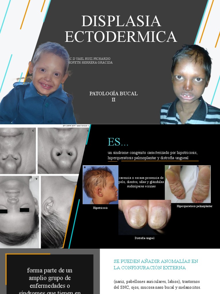 displasia ectodermica | PDF