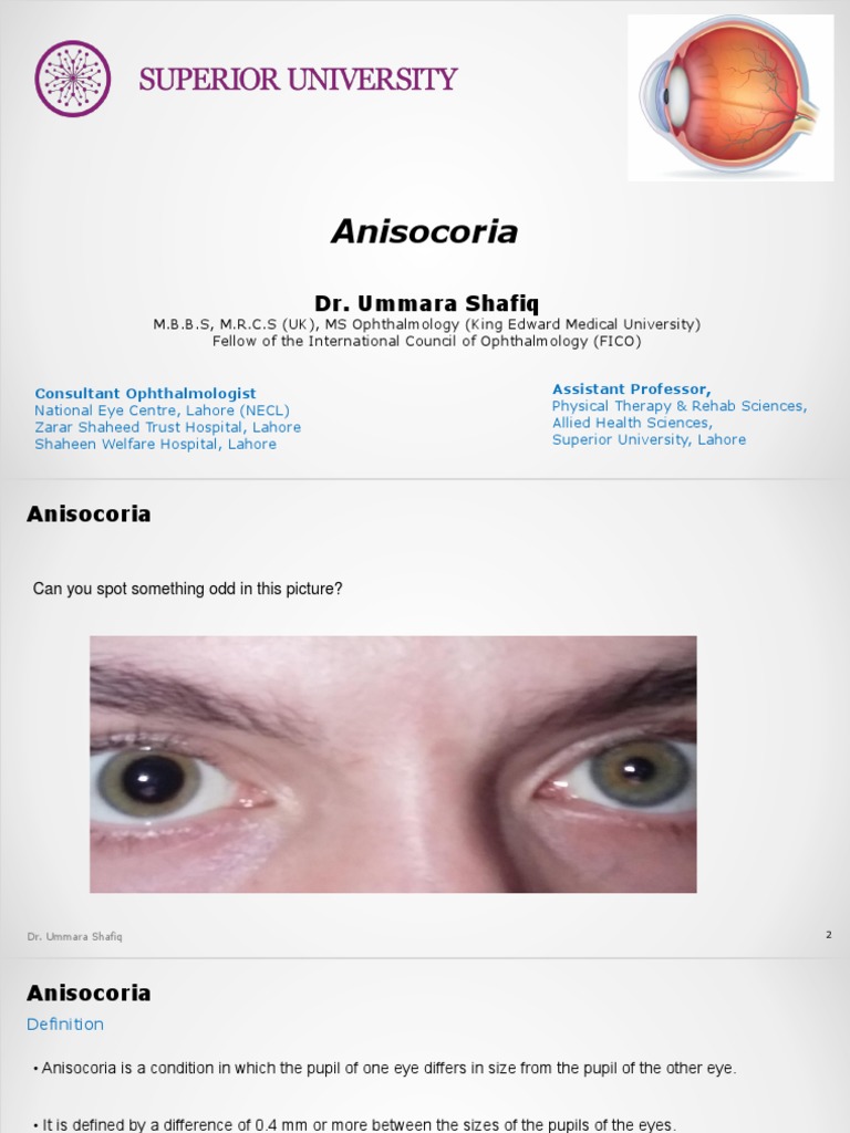 Anisocoria by Dr. Ummara Shafiq | PDF