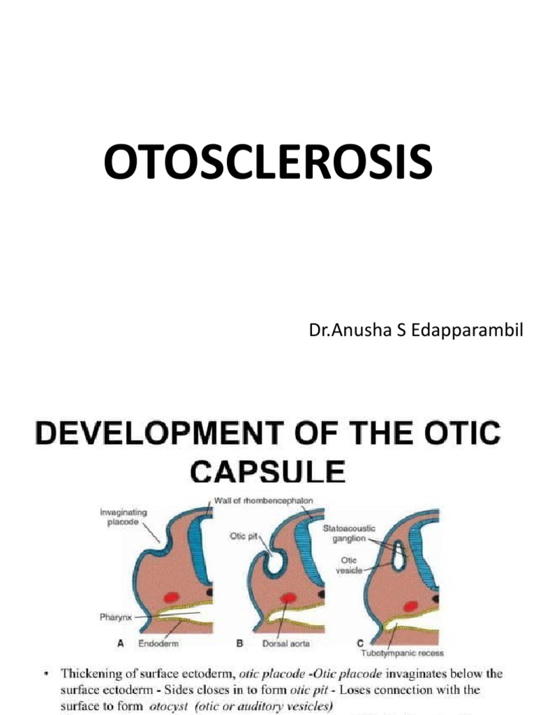 Otosclerosis | PDF