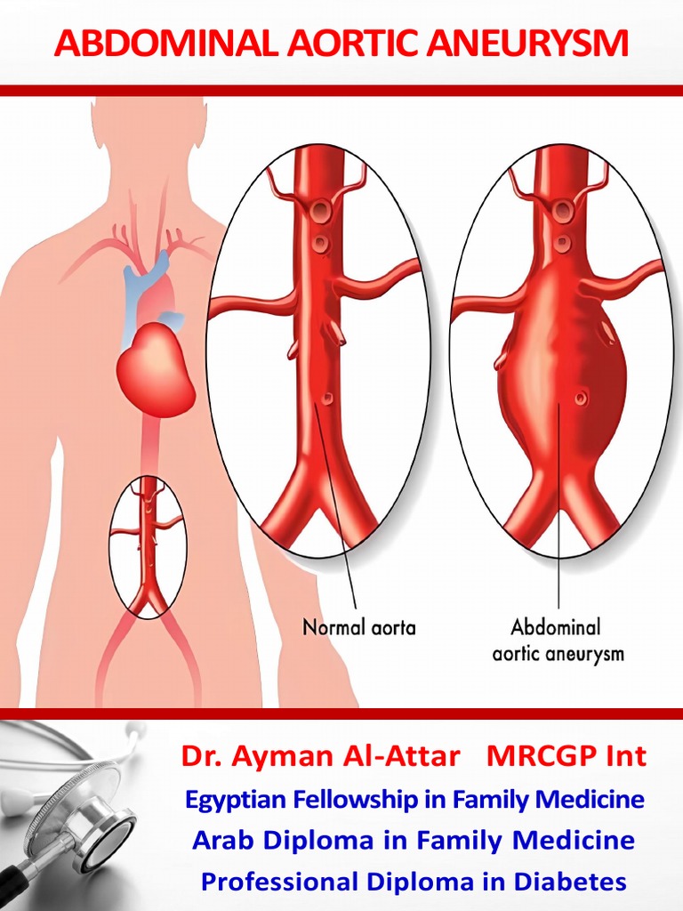 Abdominal Aortic Aneurysm | PDF | Medicine | Causes Of Death
