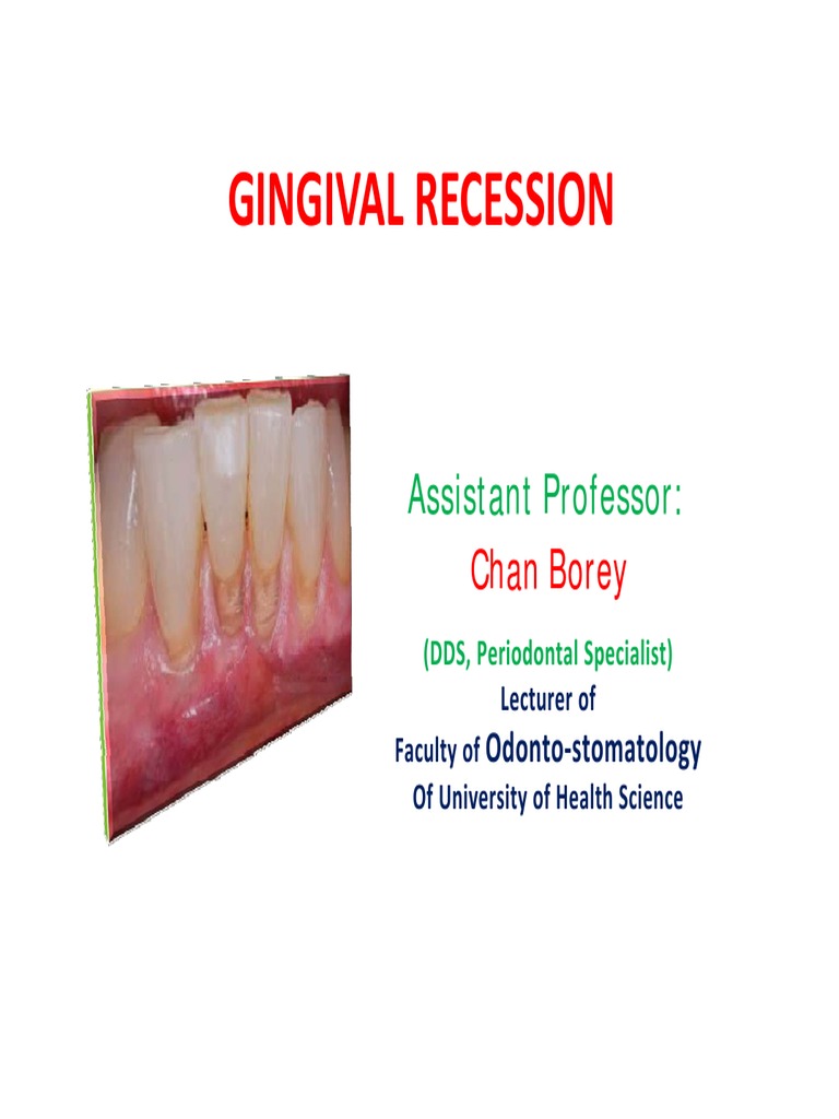 14 - Gingival Recession | Download Free PDF | Periodontology | Dentistry