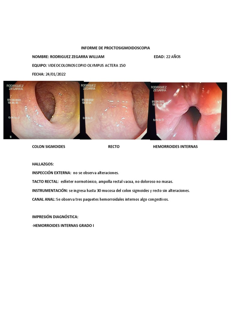 Informe de Proctosigmoidos | PDF