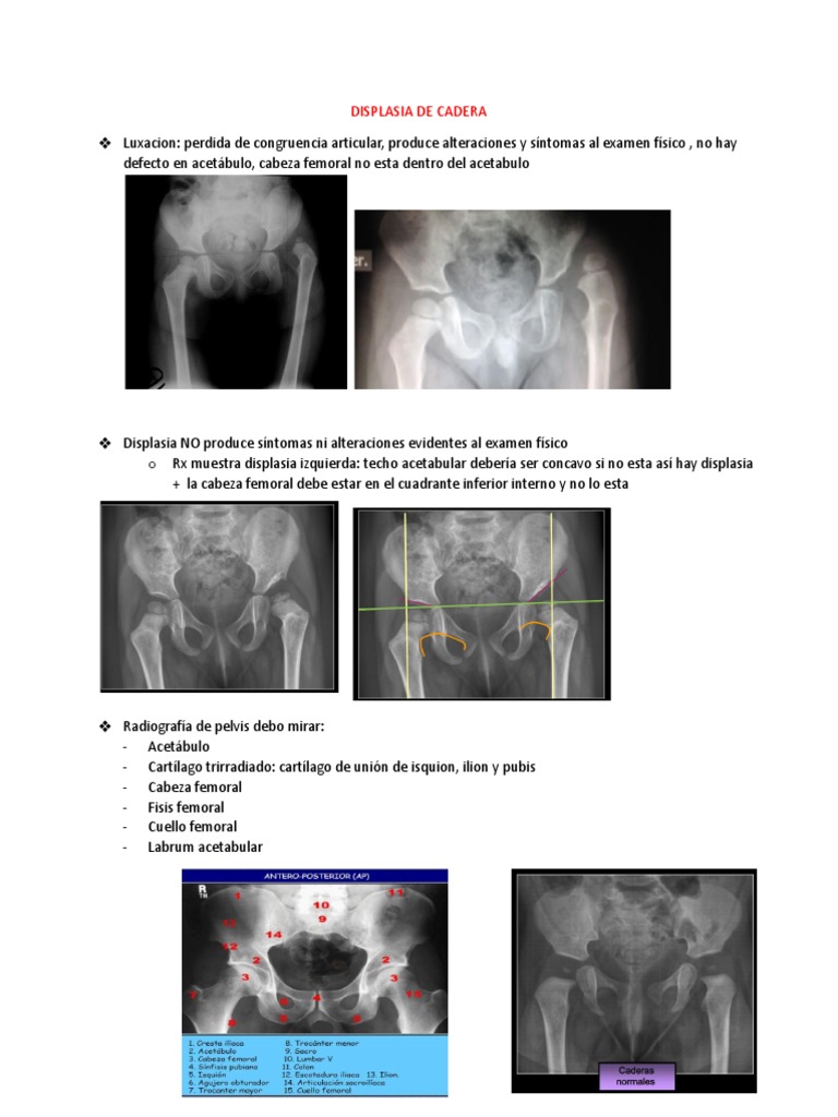 Displasia de Cadera | PDF