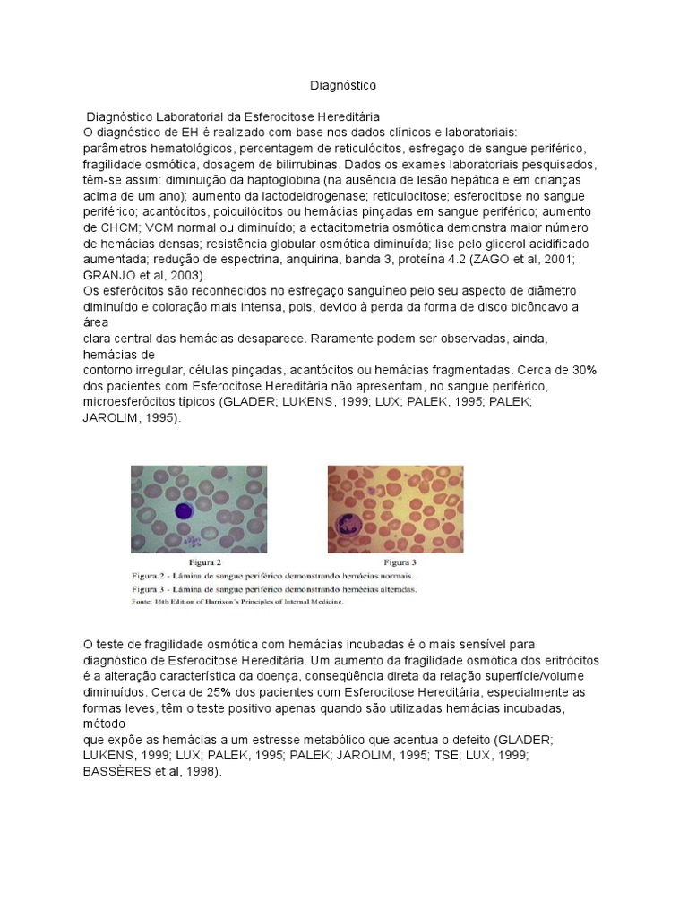 Diagnóstico Da Esferocitose Hereditária - 1 | PDF