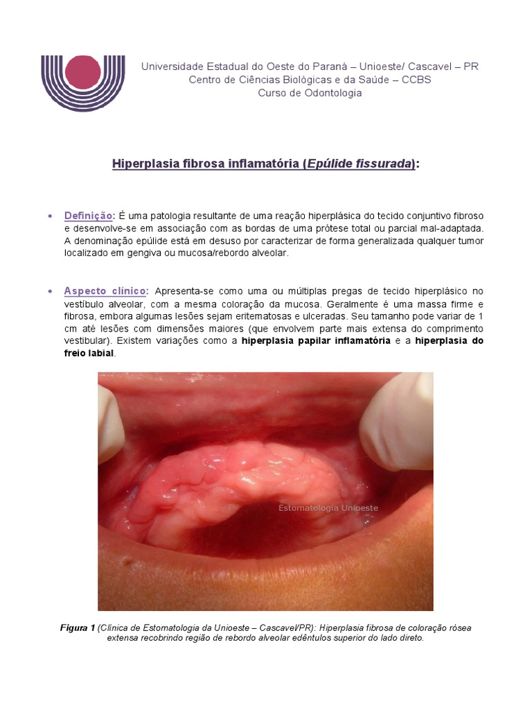 Hiperplasia Fibrosa Inflamatória (Epúlide Fissurada) | PDF