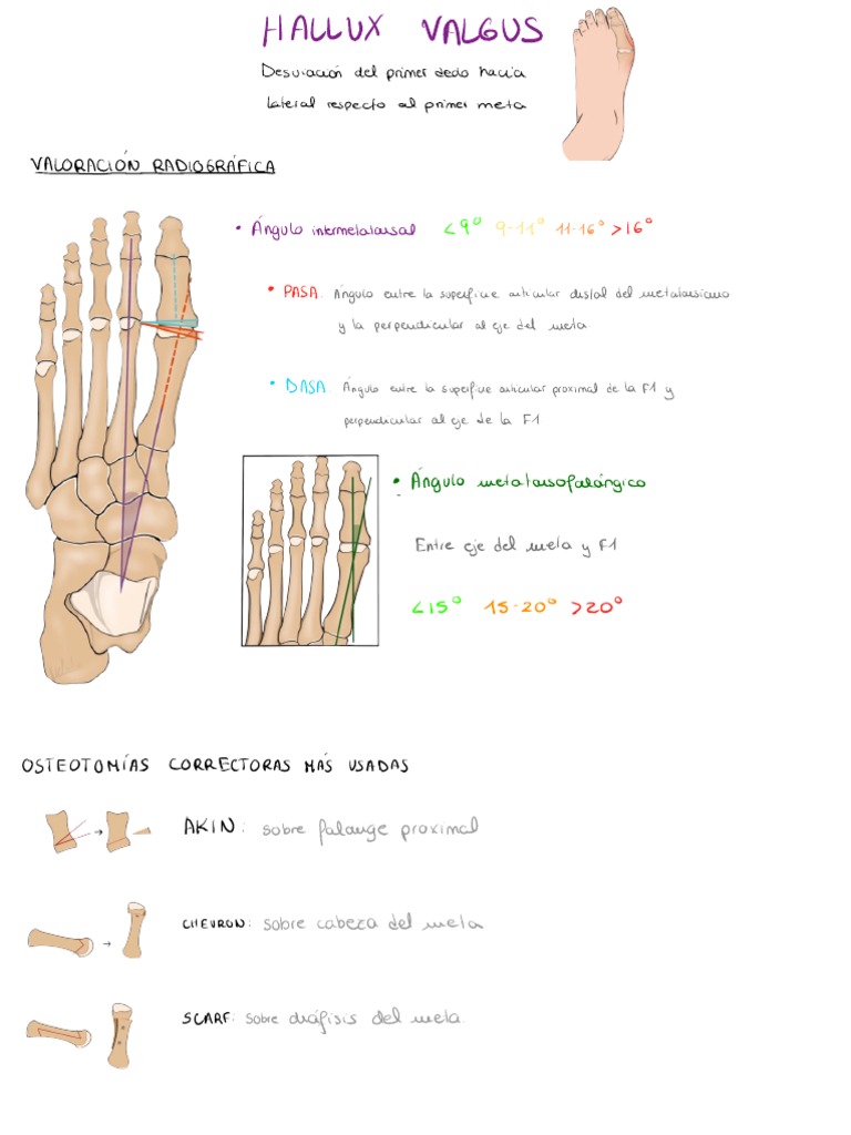 Hallux Valgus | PDF