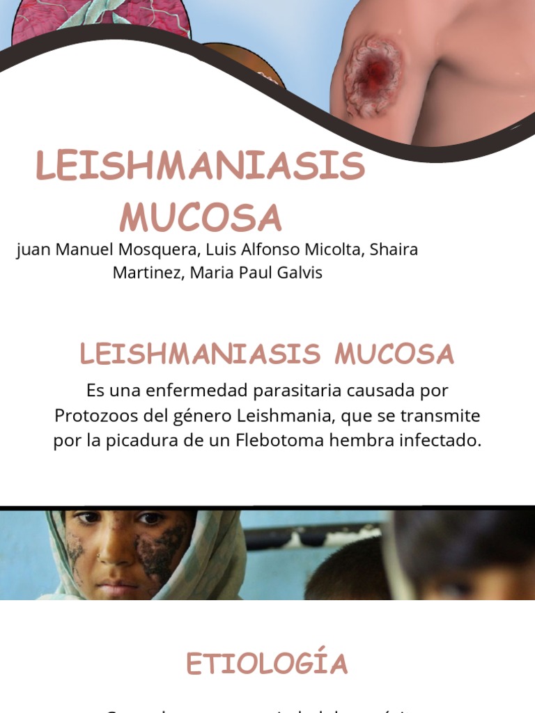 Leishmaniasis Mucosa: Causas y Riesgos | PDF | Salud y bienestar ...