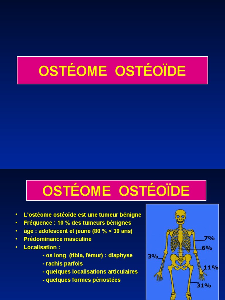 Ostéome ostéoïde : symptômes et traitement | PDF | Spécialités ...