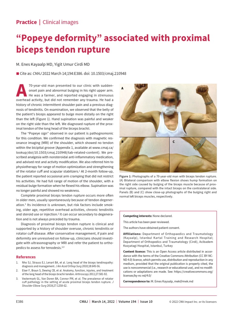 "Popeye Deformity" Associated With Proximal Biceps Tendon Rupture | PDF ...