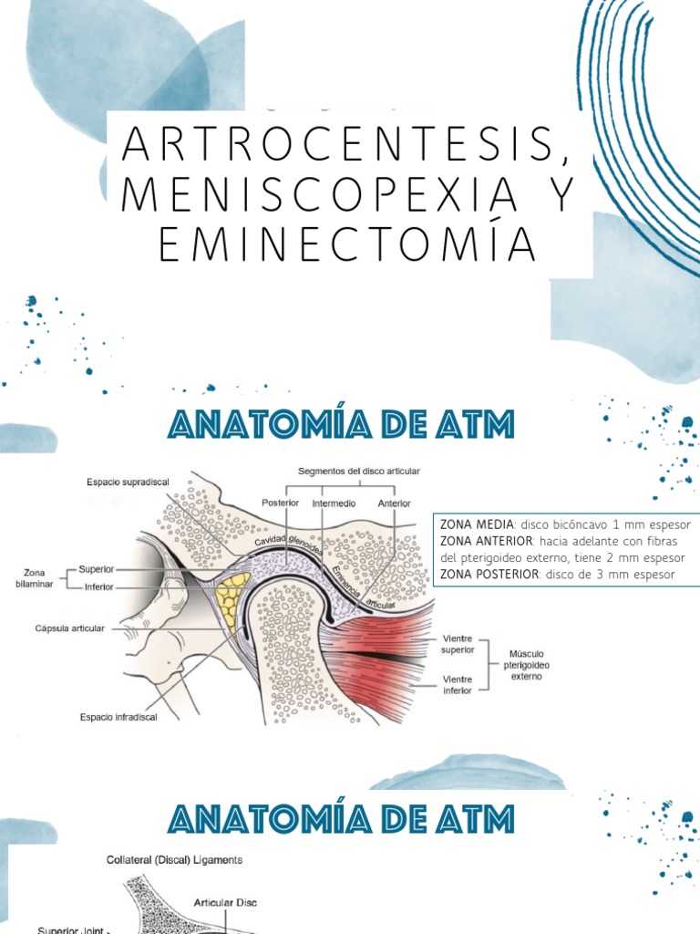 Artrocentesis y Meniscopexia en ATM | PDF