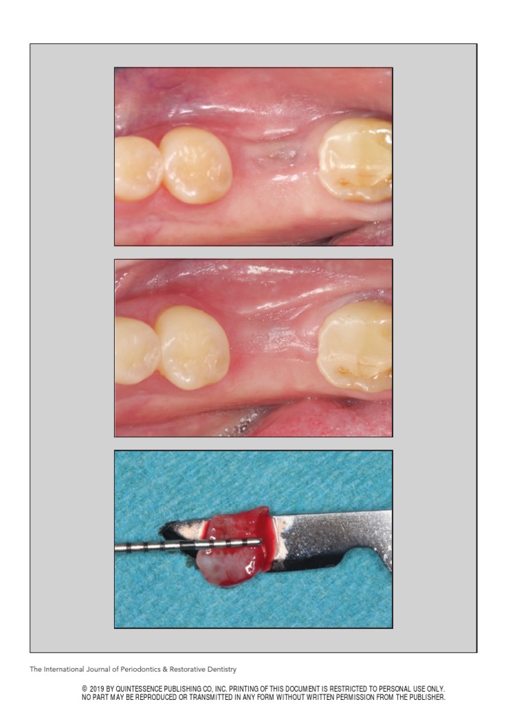AXrAamNxRPOBno93E4Pf Puisys Mucoderm Histo | PDF