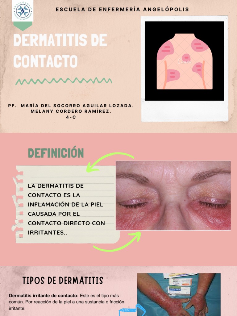 Dermatitis de Contacto | PDF