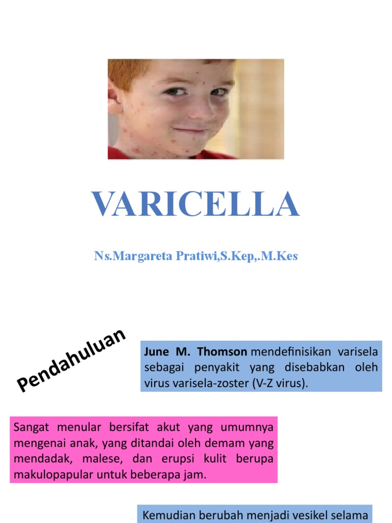 Varicella | PDF